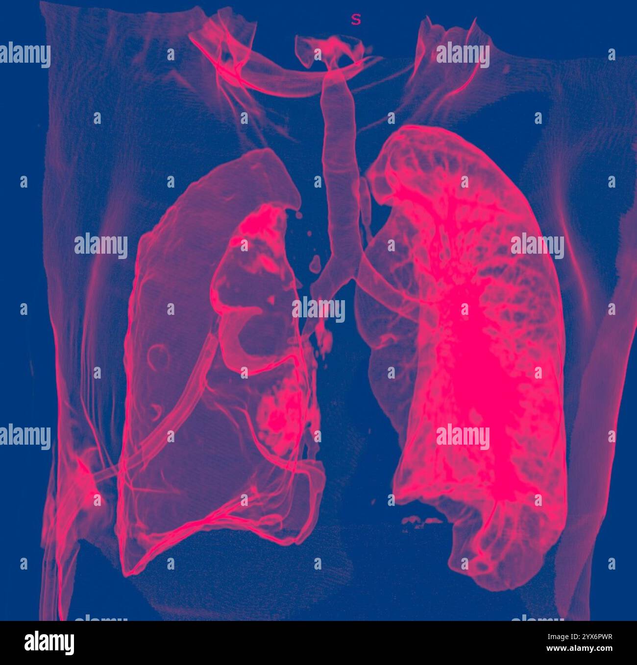 Coloured 3D computed tomography (CT) scan of the chest of a 60 year old ...