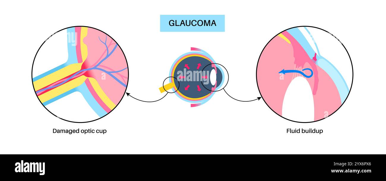Glaucoma eye disease, illustration Stock Photo - Alamy