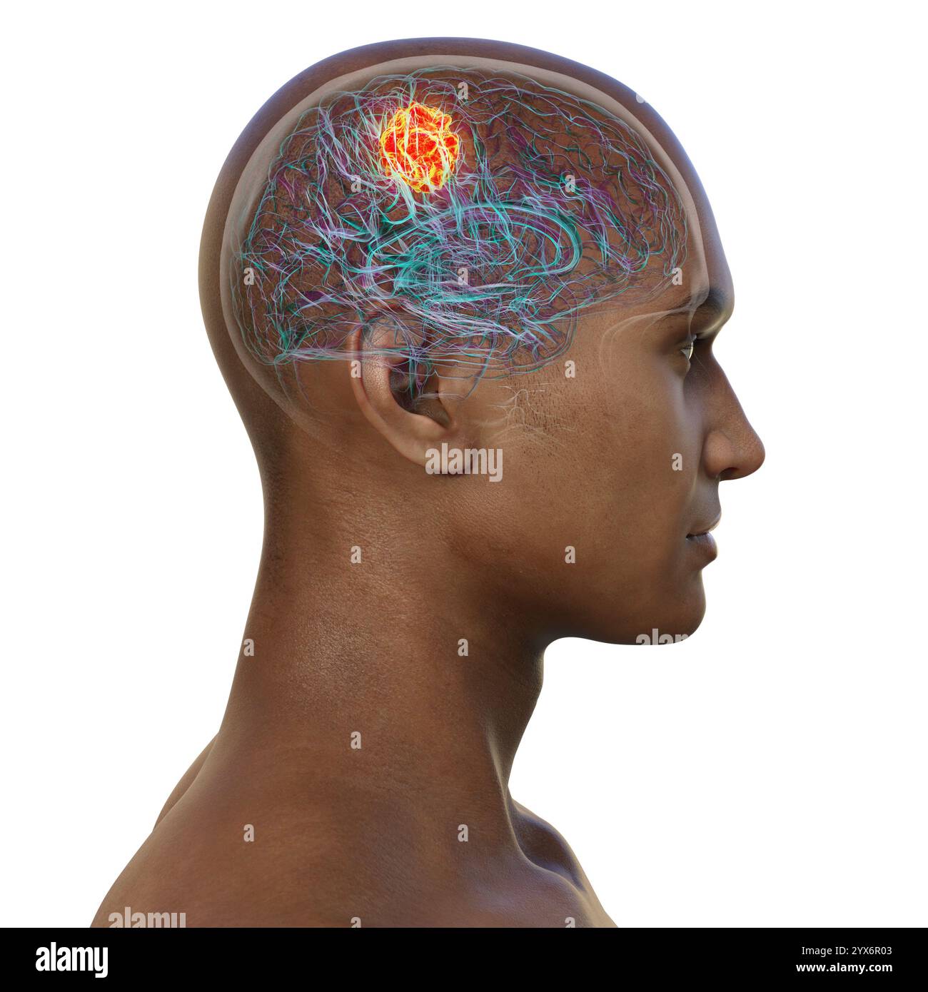 Computer illustration of a brain tumour Stock Photo - Alamy