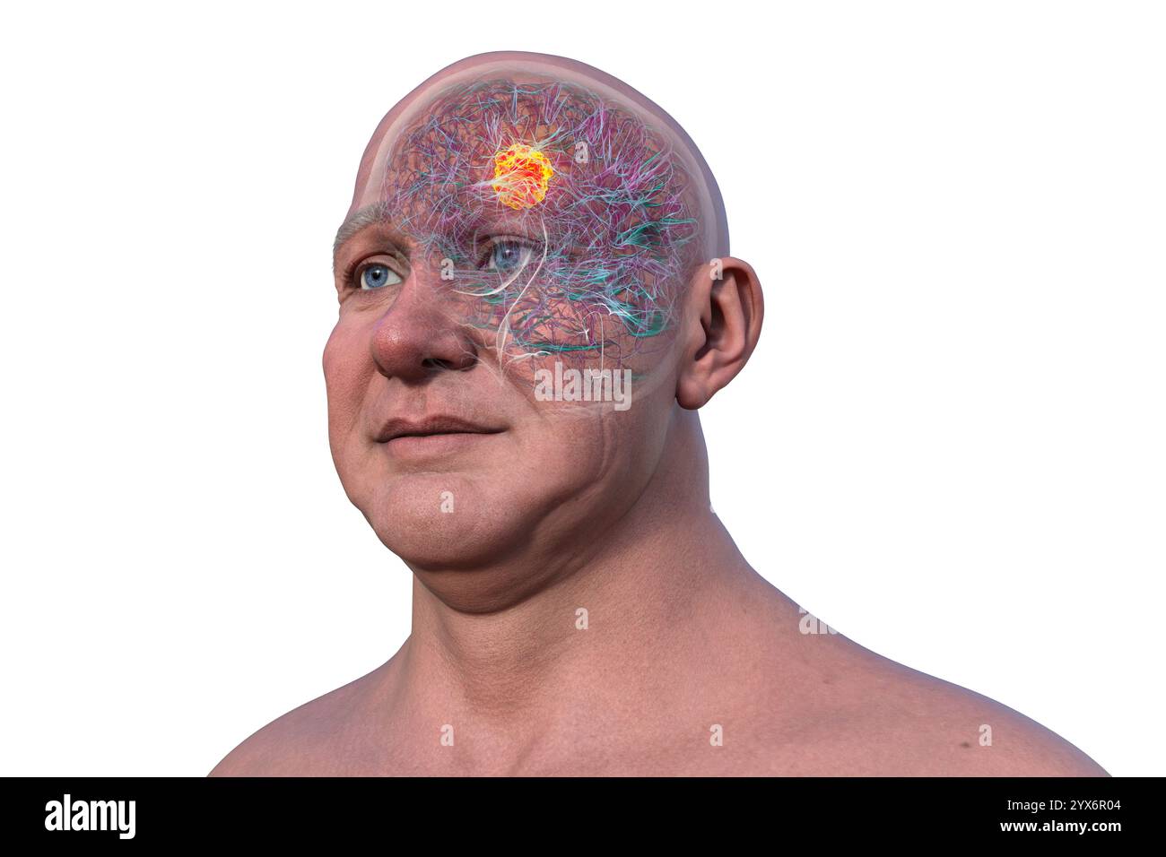 Computer illustration of a brain tumour Stock Photo - Alamy
