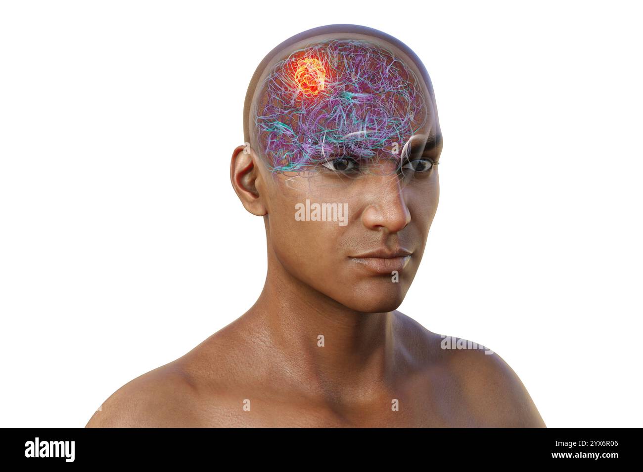 Computer illustration of a brain tumour Stock Photo - Alamy