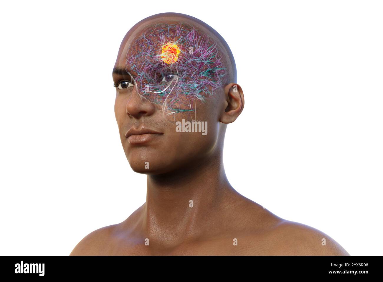 Computer illustration of a brain tumour Stock Photo - Alamy