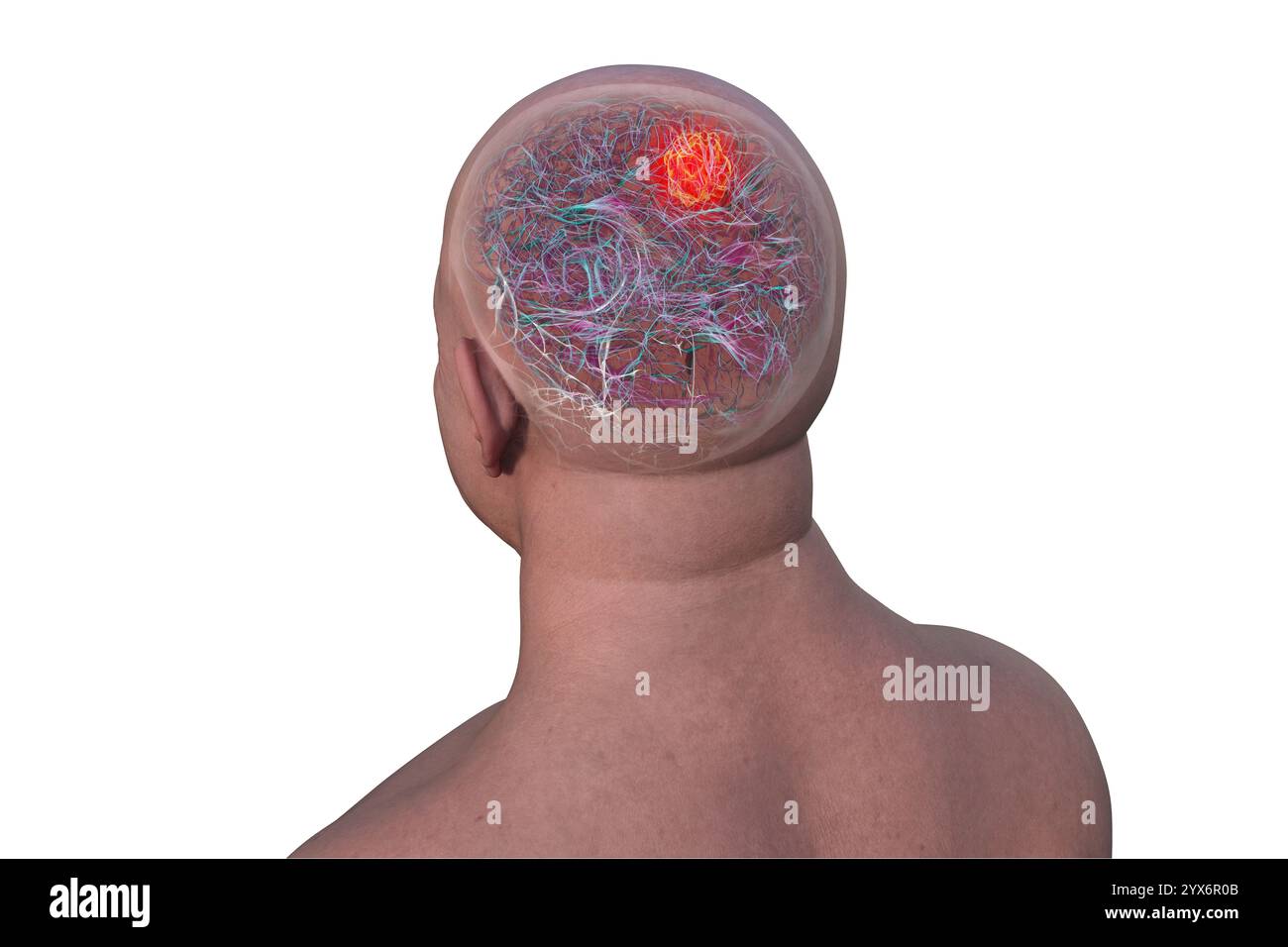 Computer illustration of a brain tumour Stock Photo - Alamy