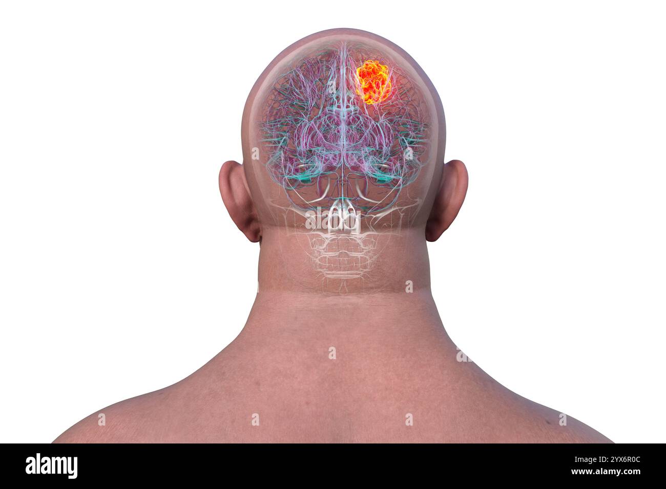 Brain tumour illustration meningioma hi-res stock photography and ...