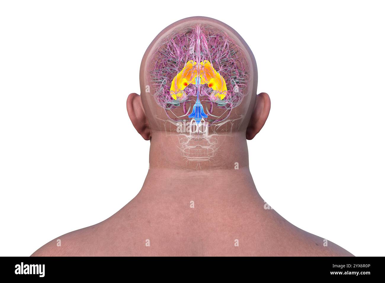 Computer illustration showing enlarged lateral ventricles ...