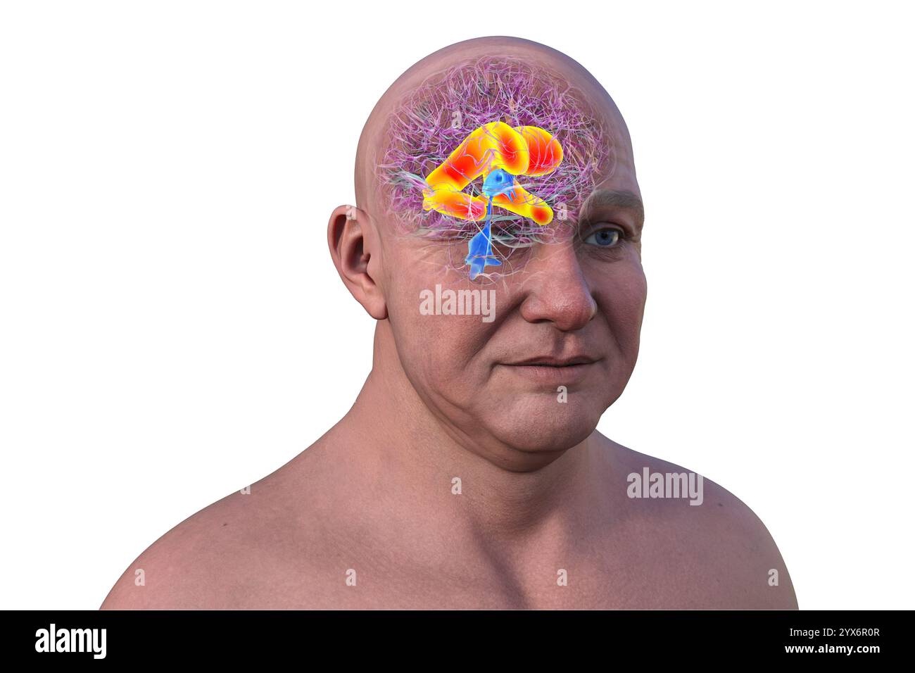 Computer illustration showing enlarged lateral ventricles ...