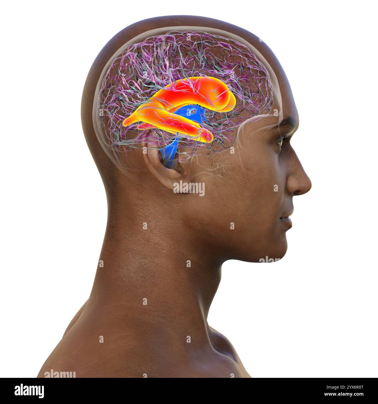 Computer illustration showing enlarged lateral ventricles ...