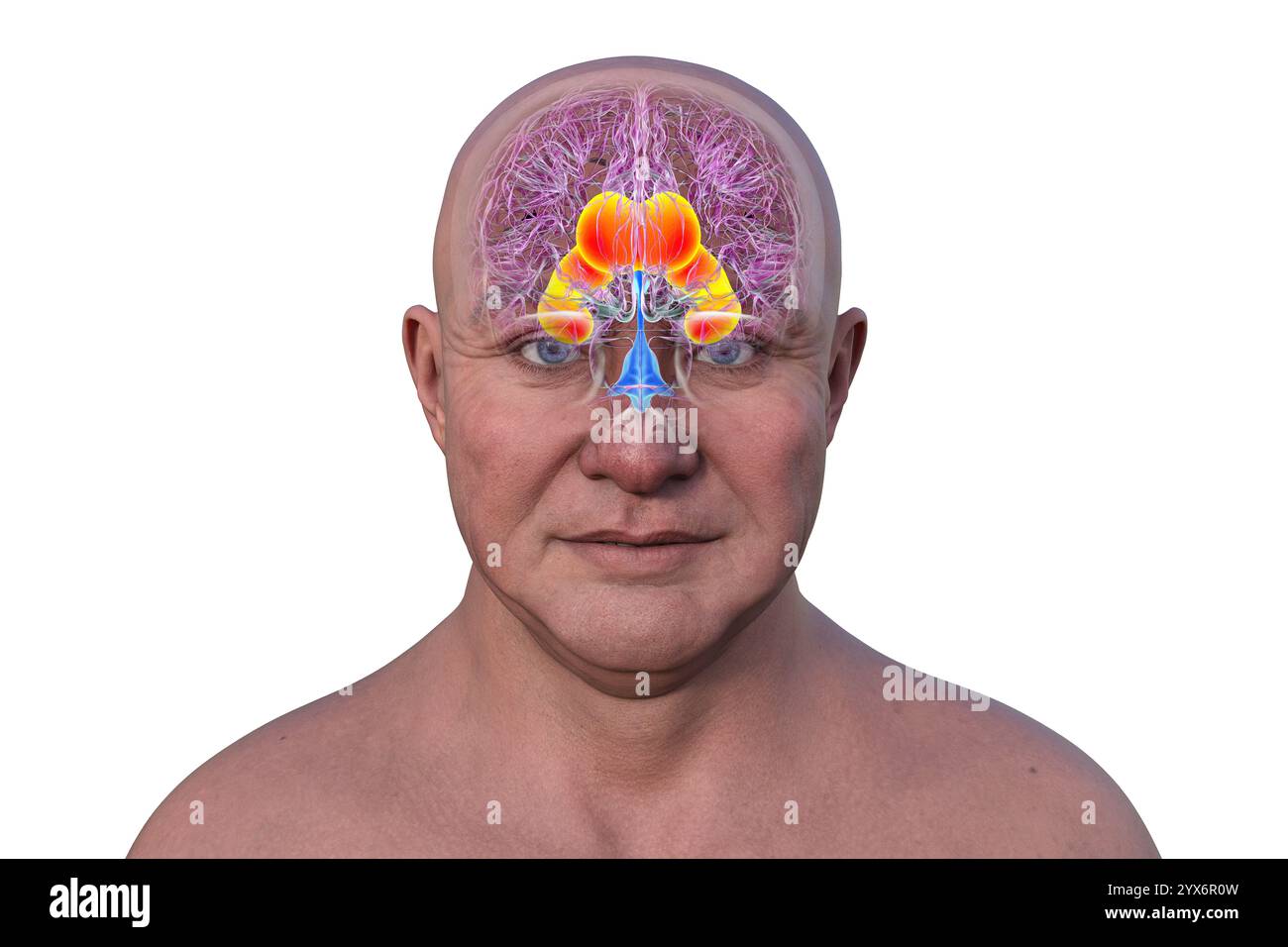Computer illustration showing enlarged lateral ventricles ...