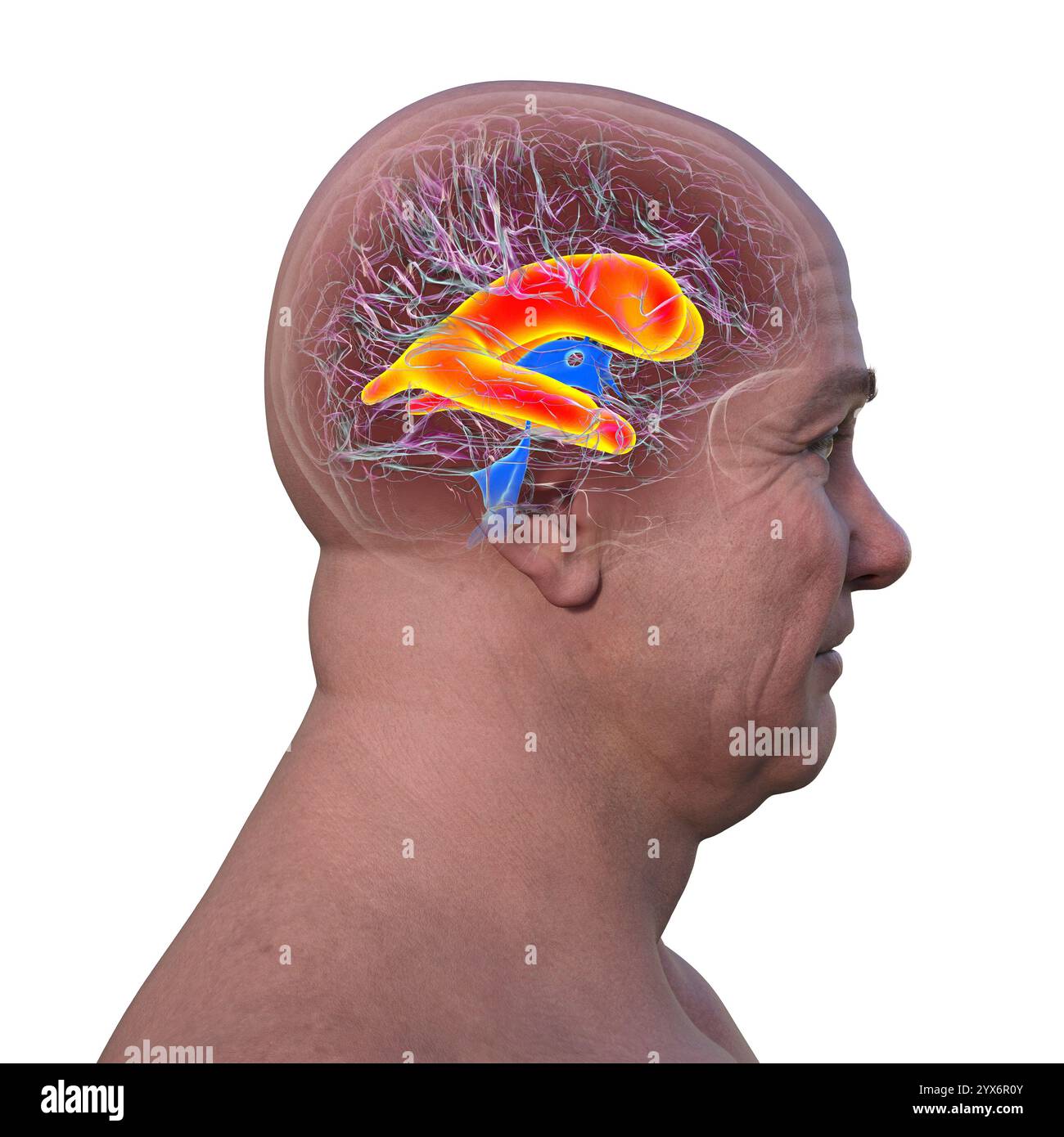 Computer illustration of enlarged lateral ventricles (hydrocephalus) of ...
