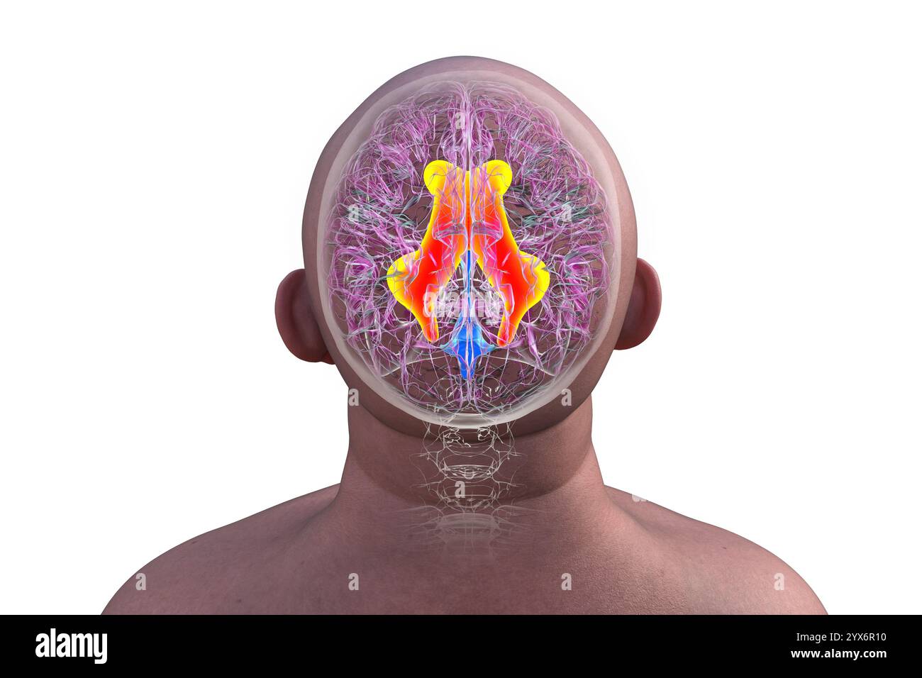 Computer illustration showing enlarged lateral ventricles ...