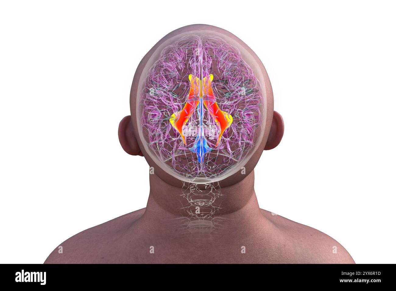 Computer illustration of the lateral brain ventricles, the largest ...