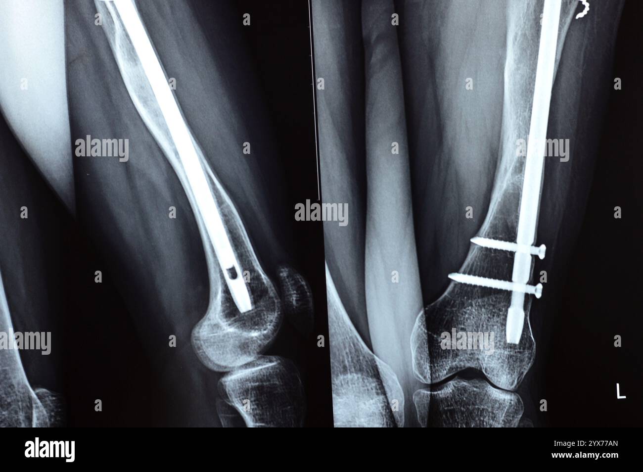 X-ray showing operative interference with intra-medullary nail ...