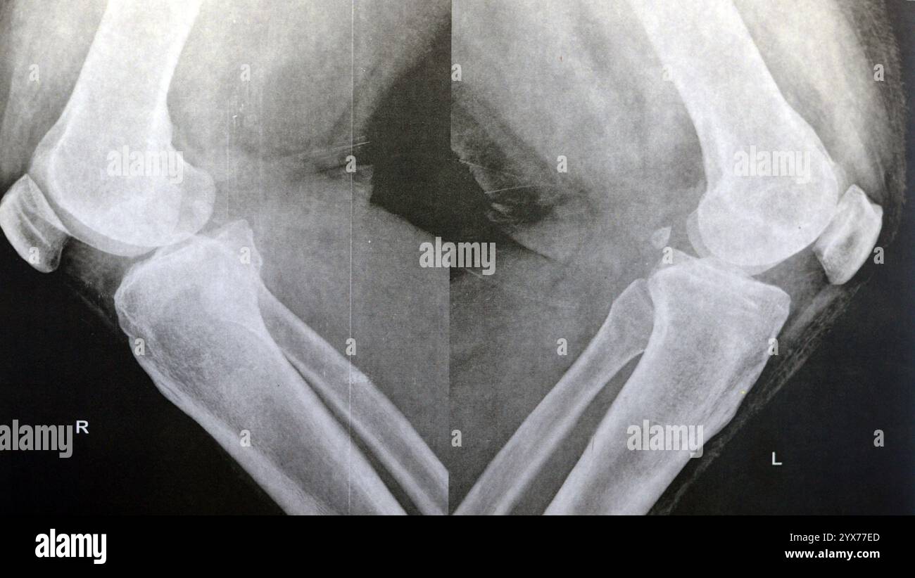 Plain x-ray of the knee showing apparent joint osteoarthritis according ...