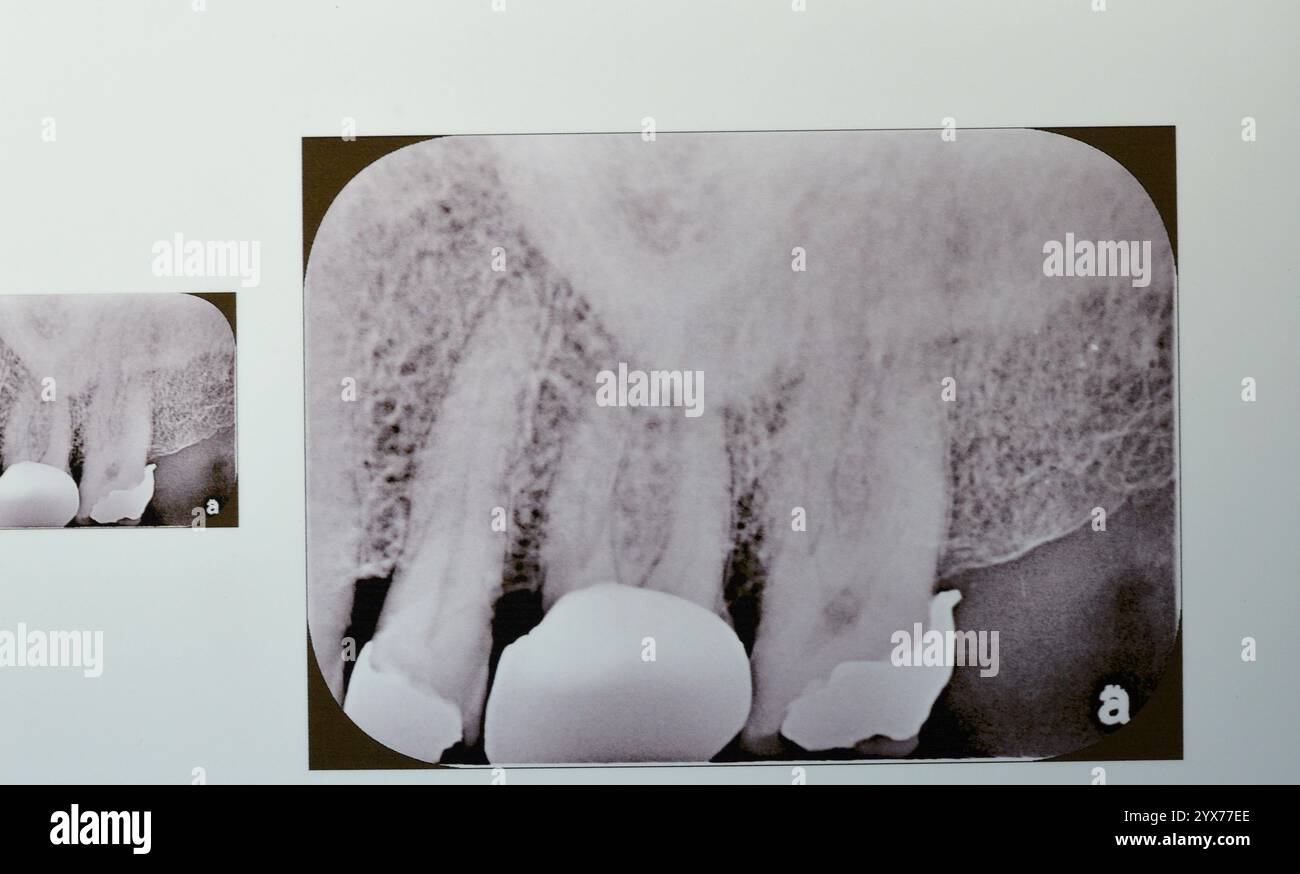 Periapical x-ray for upper 5,6 and 7 showing class II restoration in ...
