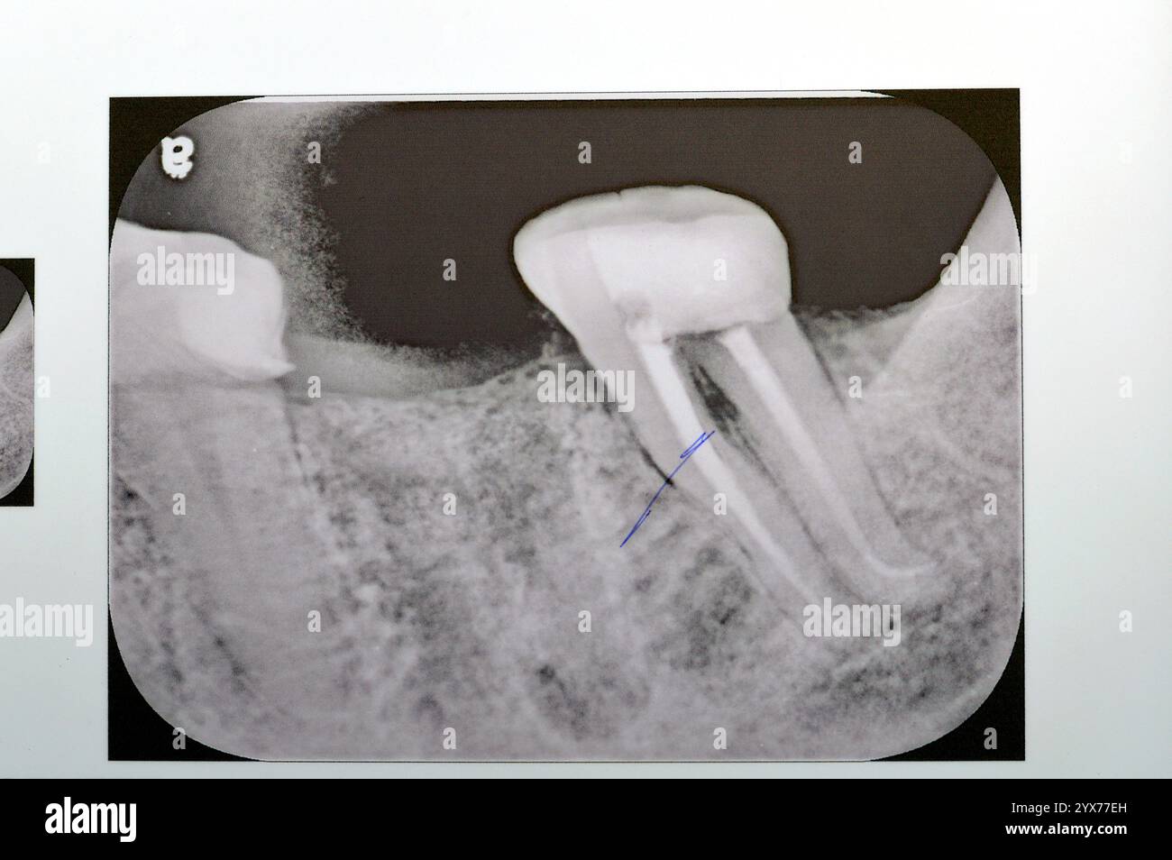 Lower molar periapical x-ray with root canal treatment with coronal ...