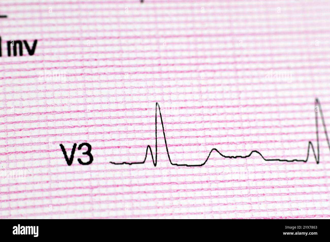 ElectroCardioGraph ECG, a chart that draws the electricity of the heart ...