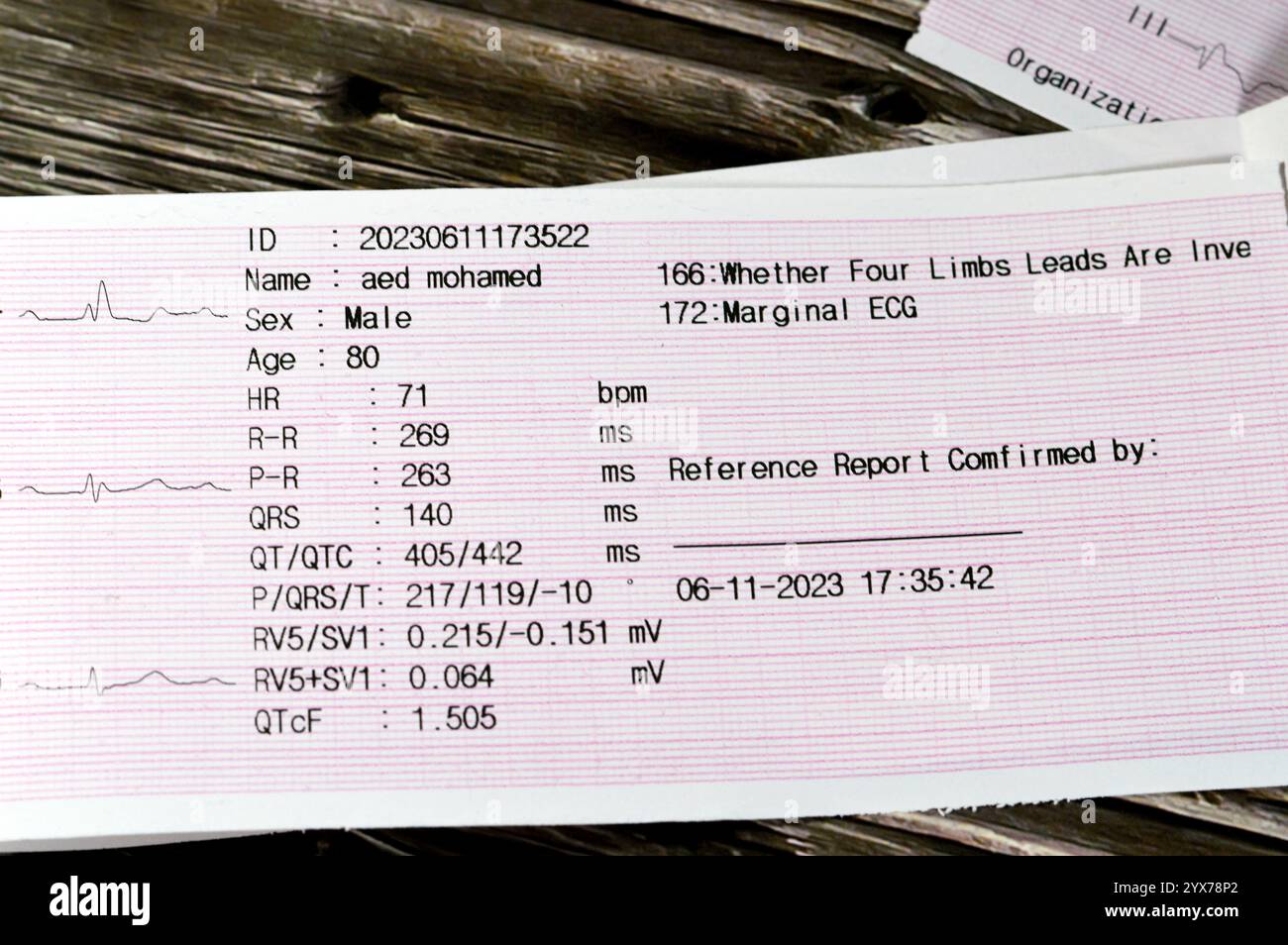 Cairo, Egypt, November 15 2024: ElectroCardioGraph ECG, a chart that ...