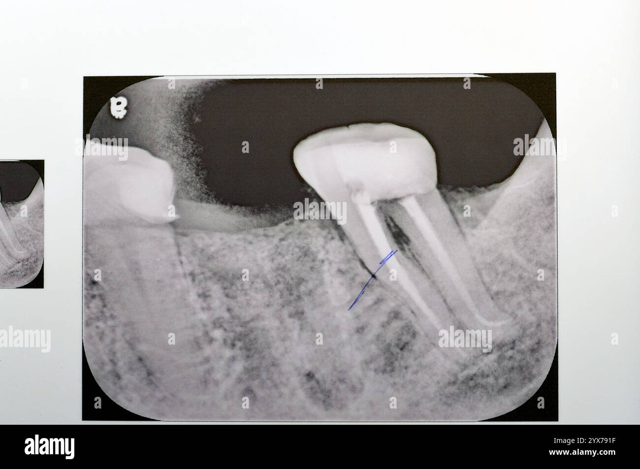 Lower molar periapical x-ray with root canal treatment with coronal ...