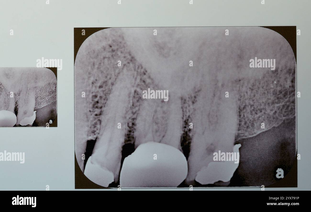 Periapical x-ray for upper 5,6 and 7 showing class II restoration in ...