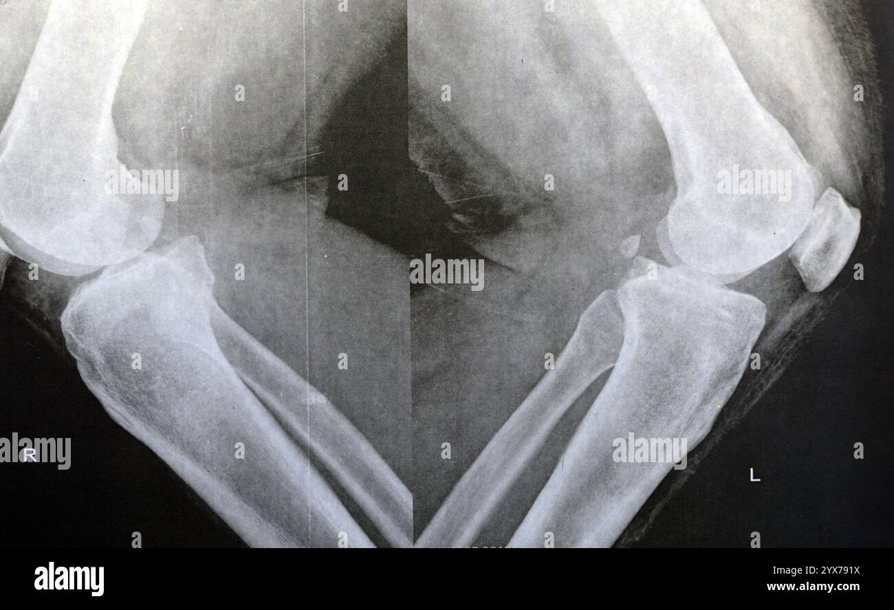 Plain x-ray of the knee showing apparent joint osteoarthritis according ...