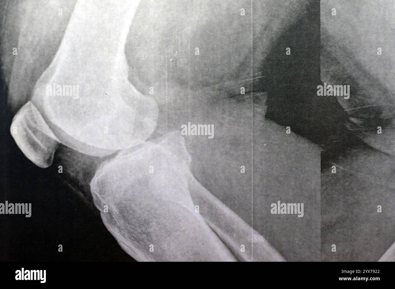 Plain x-ray of the knee showing apparent joint osteoarthritis according ...