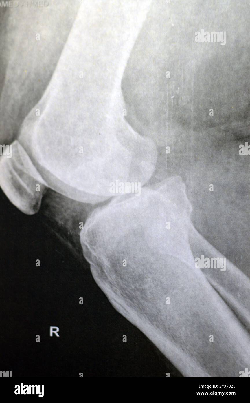 Plain x-ray of the knee showing apparent joint osteoarthritis according ...