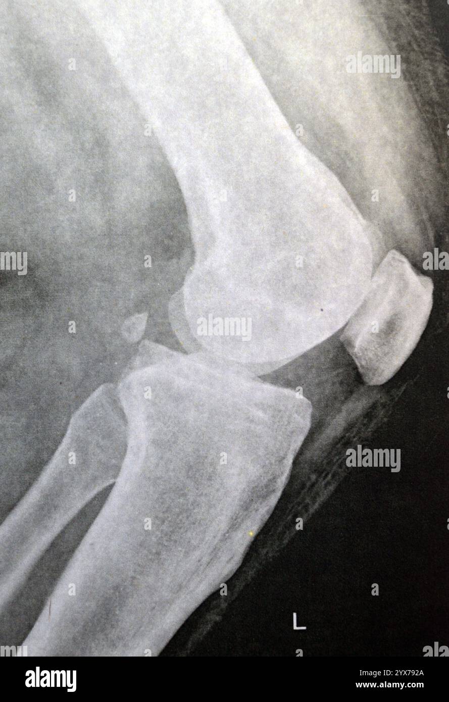 Plain x-ray of the knee showing apparent joint osteoarthritis according ...