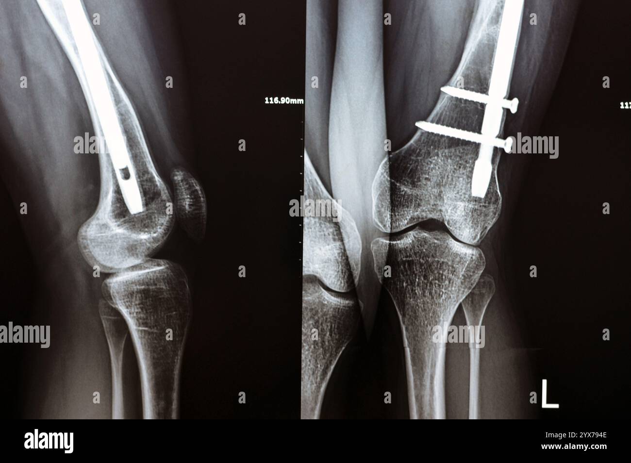 X-ray showing operative interference with intra-medullary nail ...