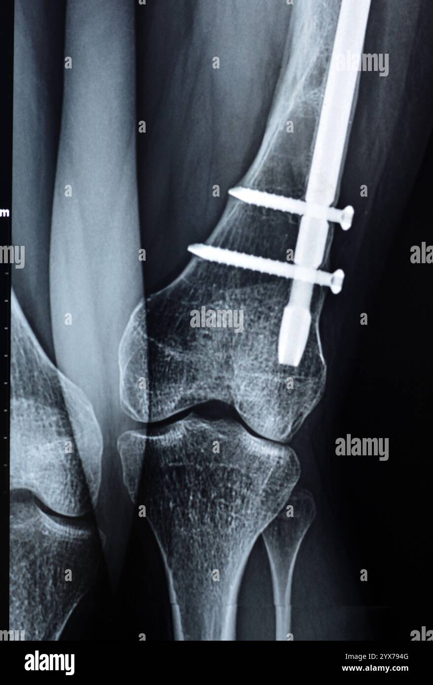 X-ray showing operative interference with intra-medullary nail ...