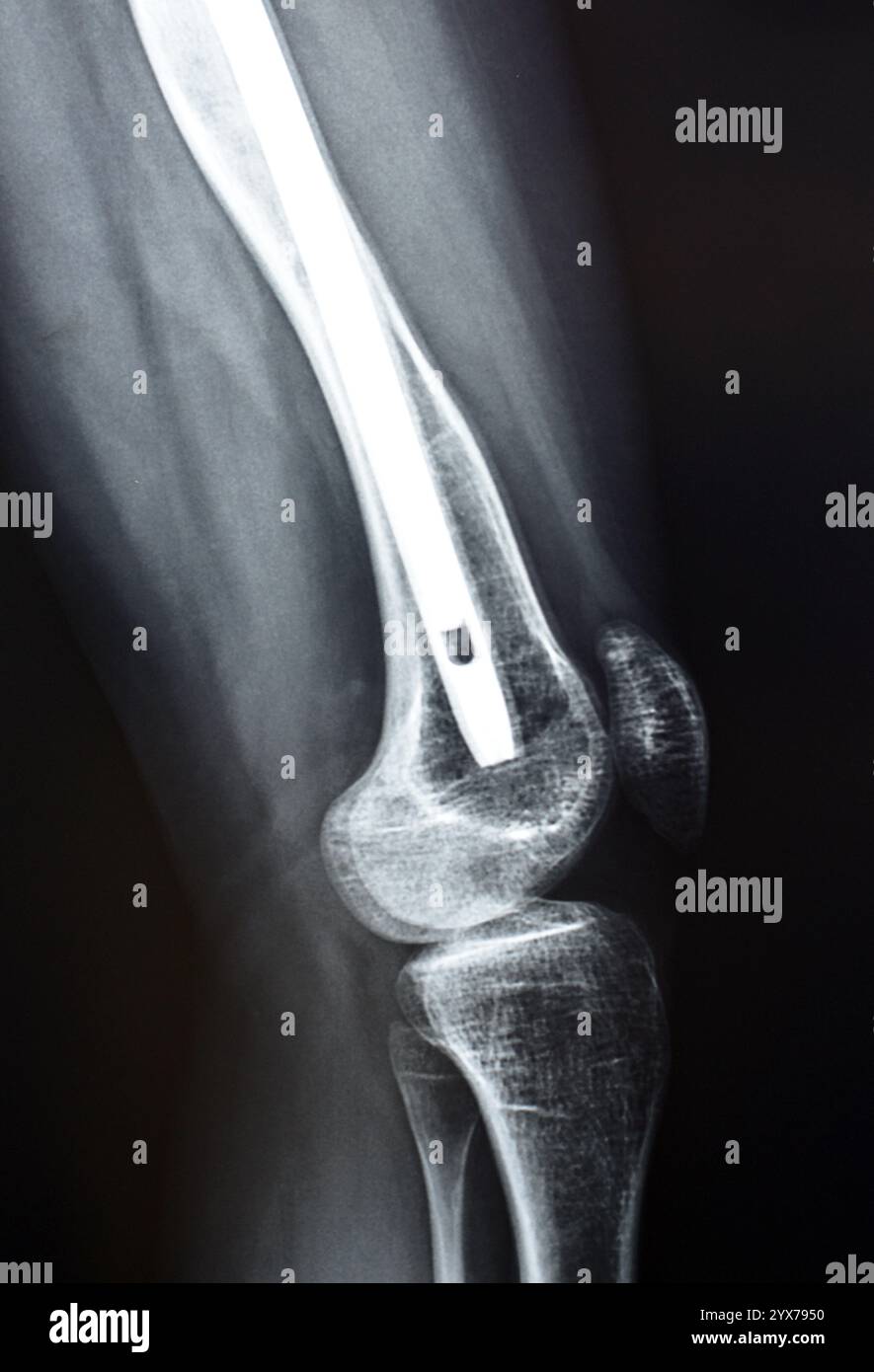 X-ray showing operative interference with intra-medullary nail ...