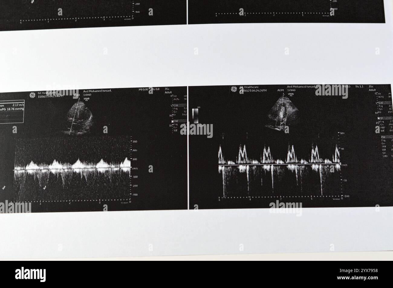 Cairo, Egypt, November 15 2024: cardiac ultrasound, Echocardiography, a ...