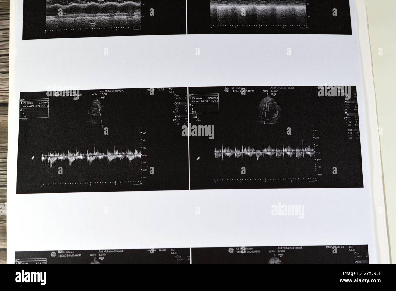 Cairo, Egypt, November 15 2024: cardiac ultrasound, Echocardiography, a ...