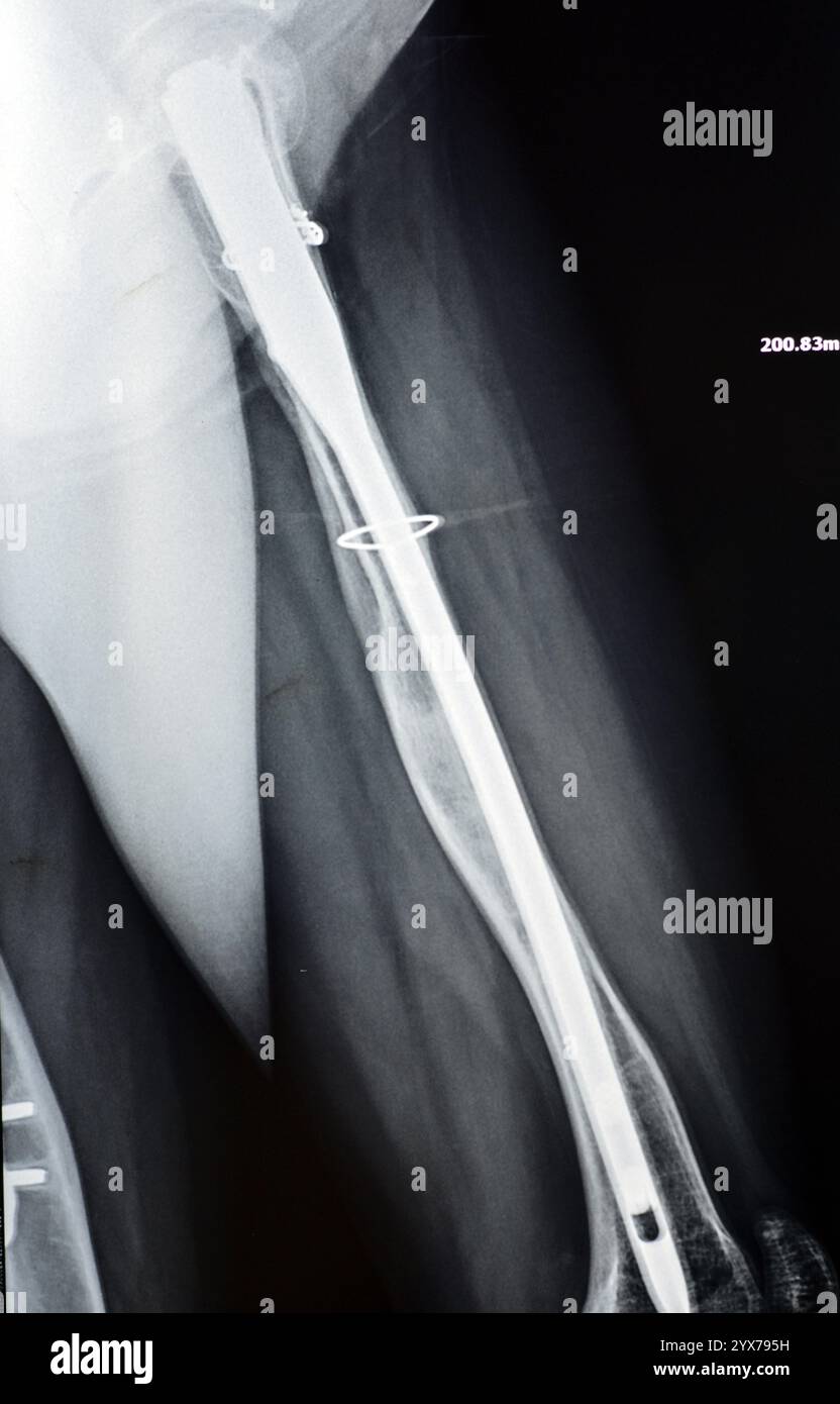 X-ray showing operative interference with intra-medullary nail ...