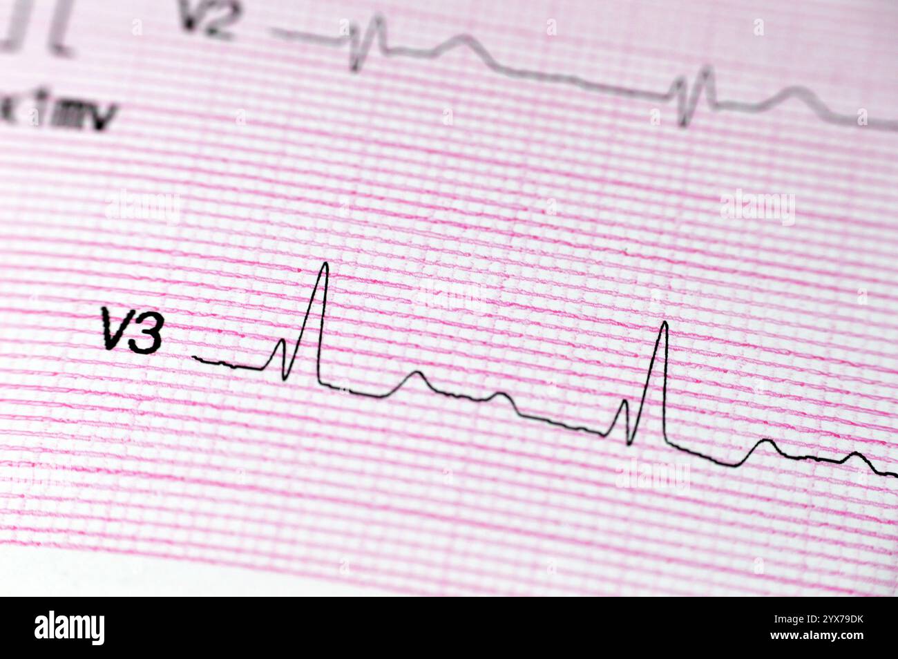 ElectroCardioGraph ECG, a chart that draws the electricity of the heart ...