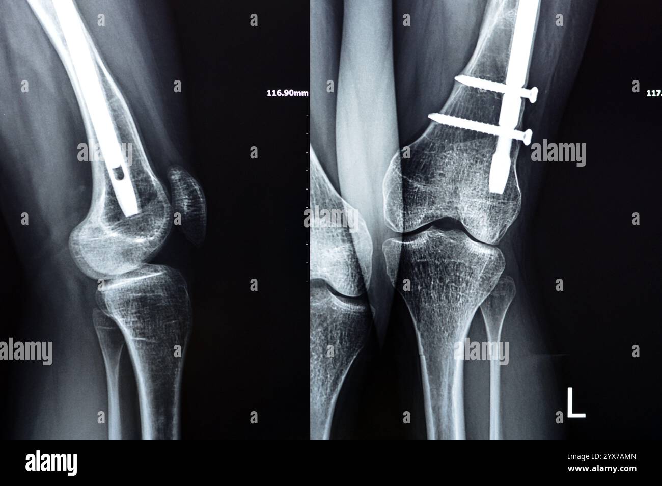 X-ray showing operative interference with intra-medullary nail ...