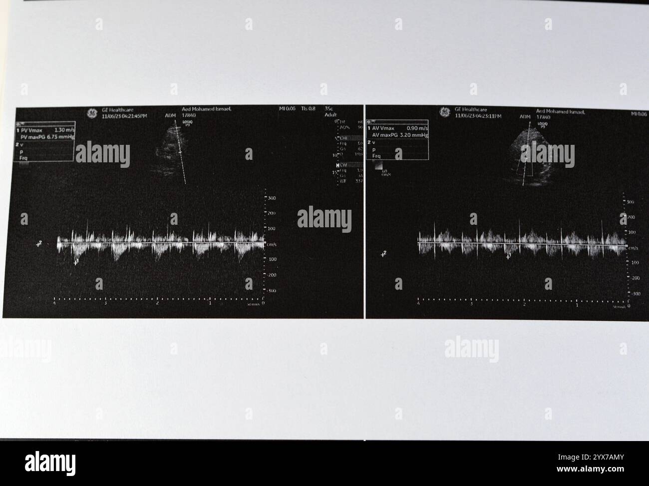 Cairo, Egypt, November 15 2024: cardiac ultrasound, Echocardiography, a ...