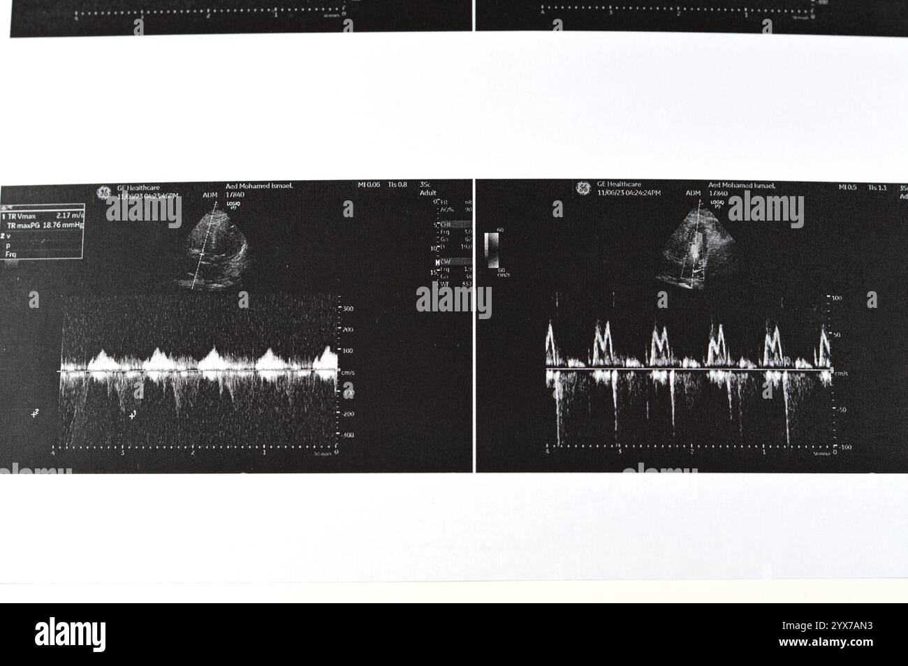 Cairo, Egypt, November 15 2024: cardiac ultrasound, Echocardiography, a ...
