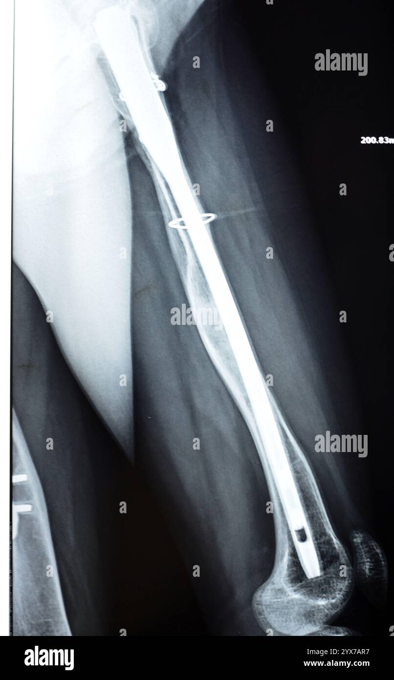 X-ray showing operative interference with intra-medullary nail ...