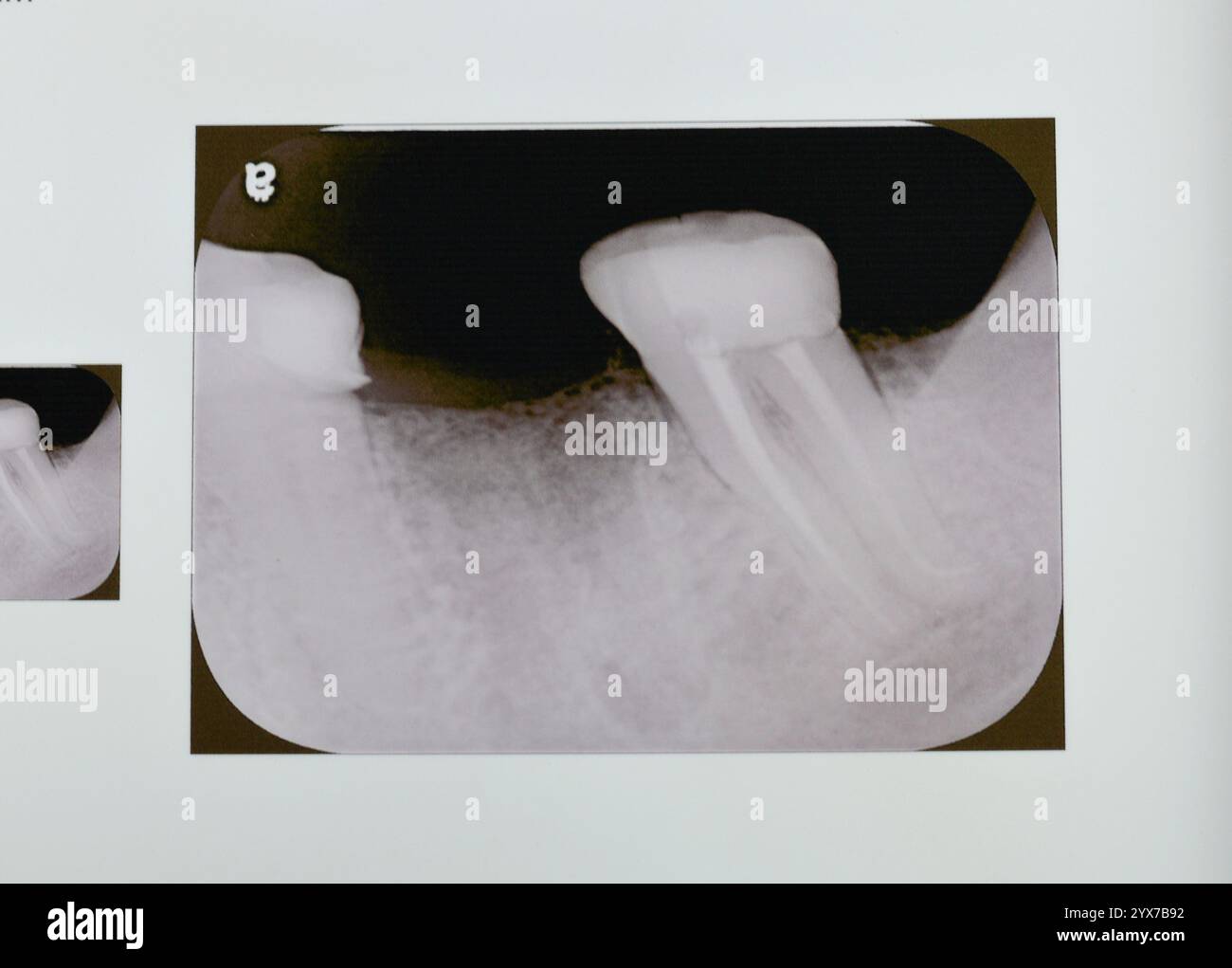 Lower molar periapical x-ray with root canal treatment with coronal ...