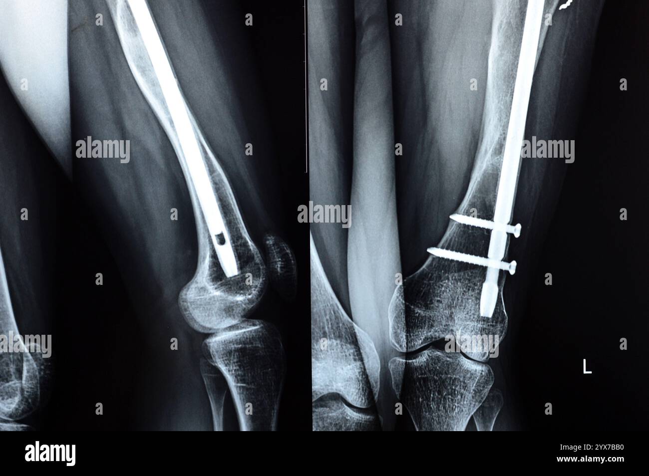 X-ray showing operative interference with intra-medullary nail ...