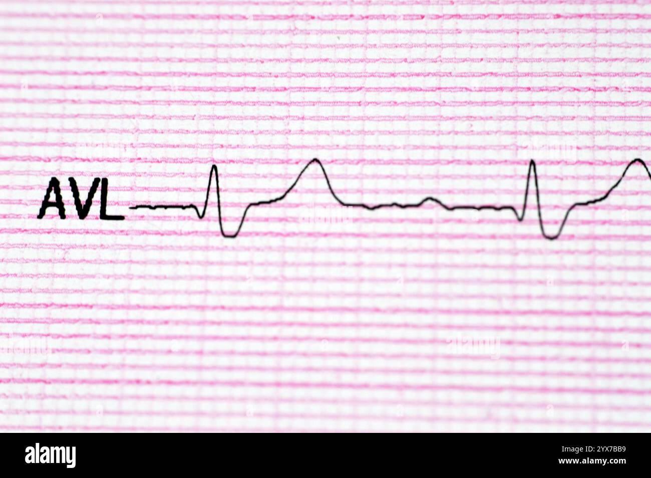 ElectroCardioGraph ECG, a chart that draws the electricity of the heart ...