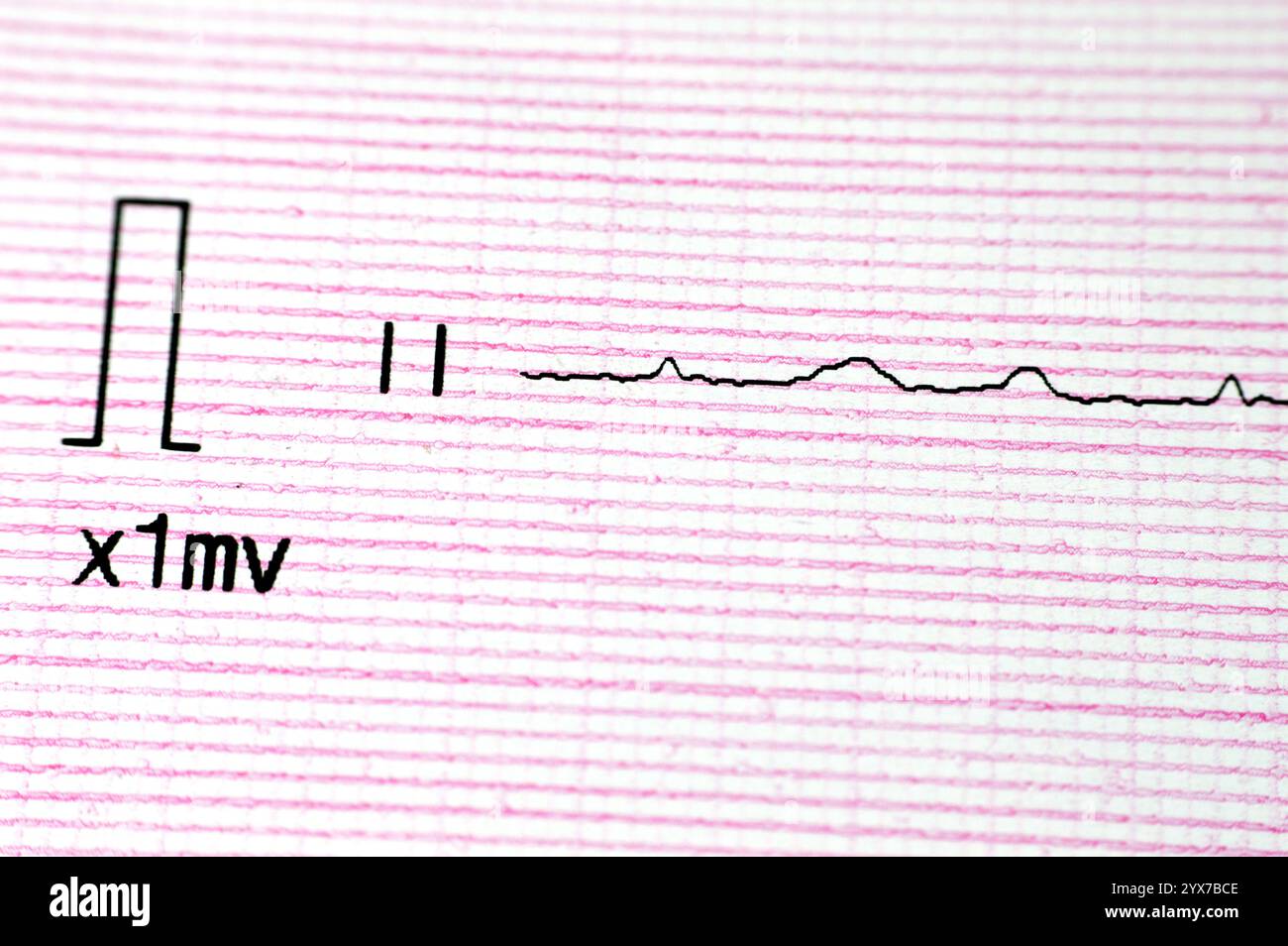 ElectroCardioGraph ECG, a chart that draws the electricity of the heart ...