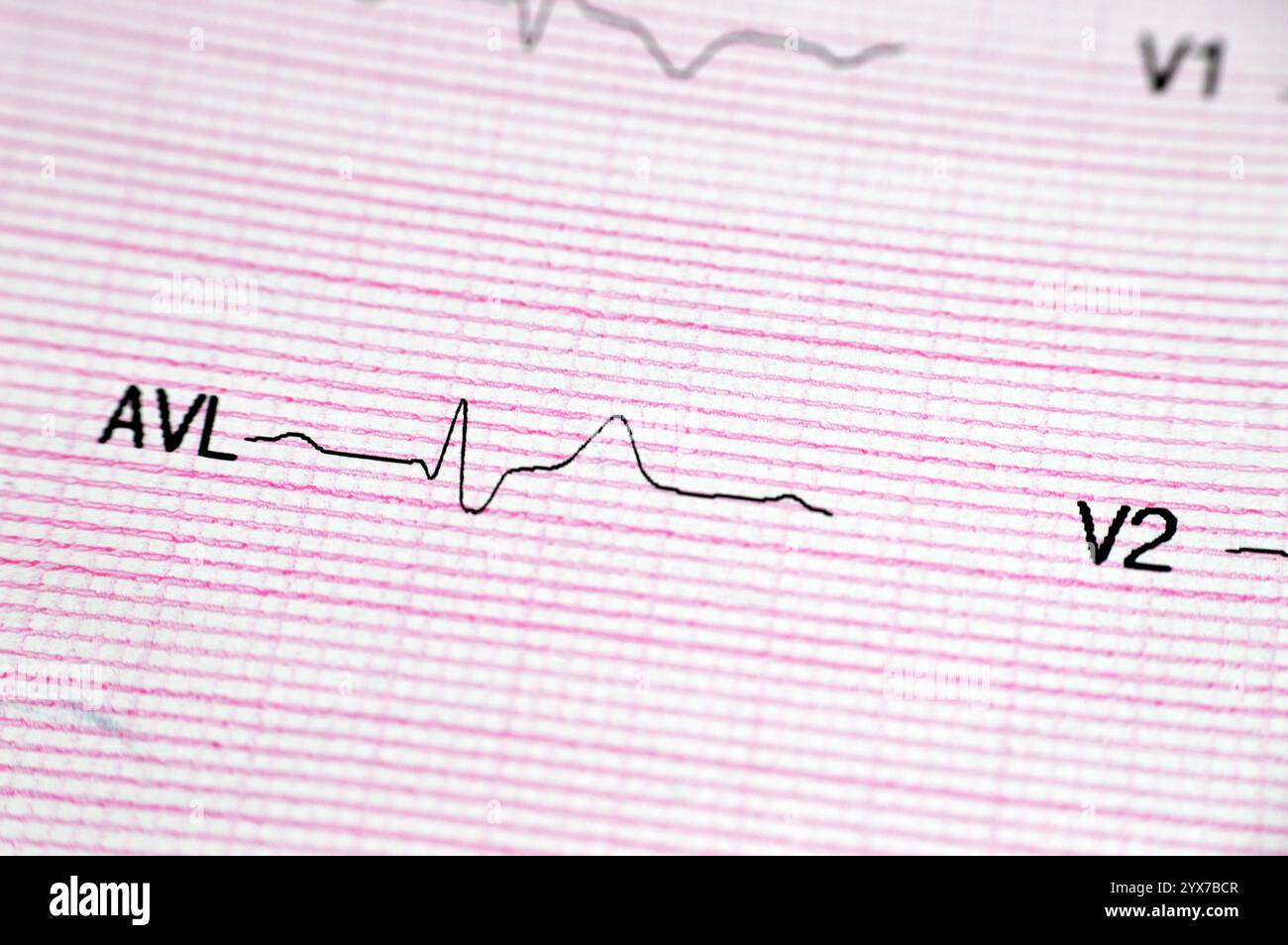 ElectroCardioGraph ECG, a chart that draws the electricity of the heart ...