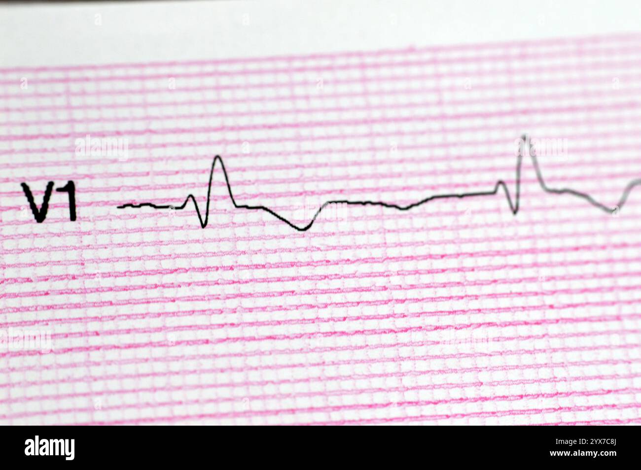 ElectroCardioGraph ECG, a chart that draws the electricity of the heart ...