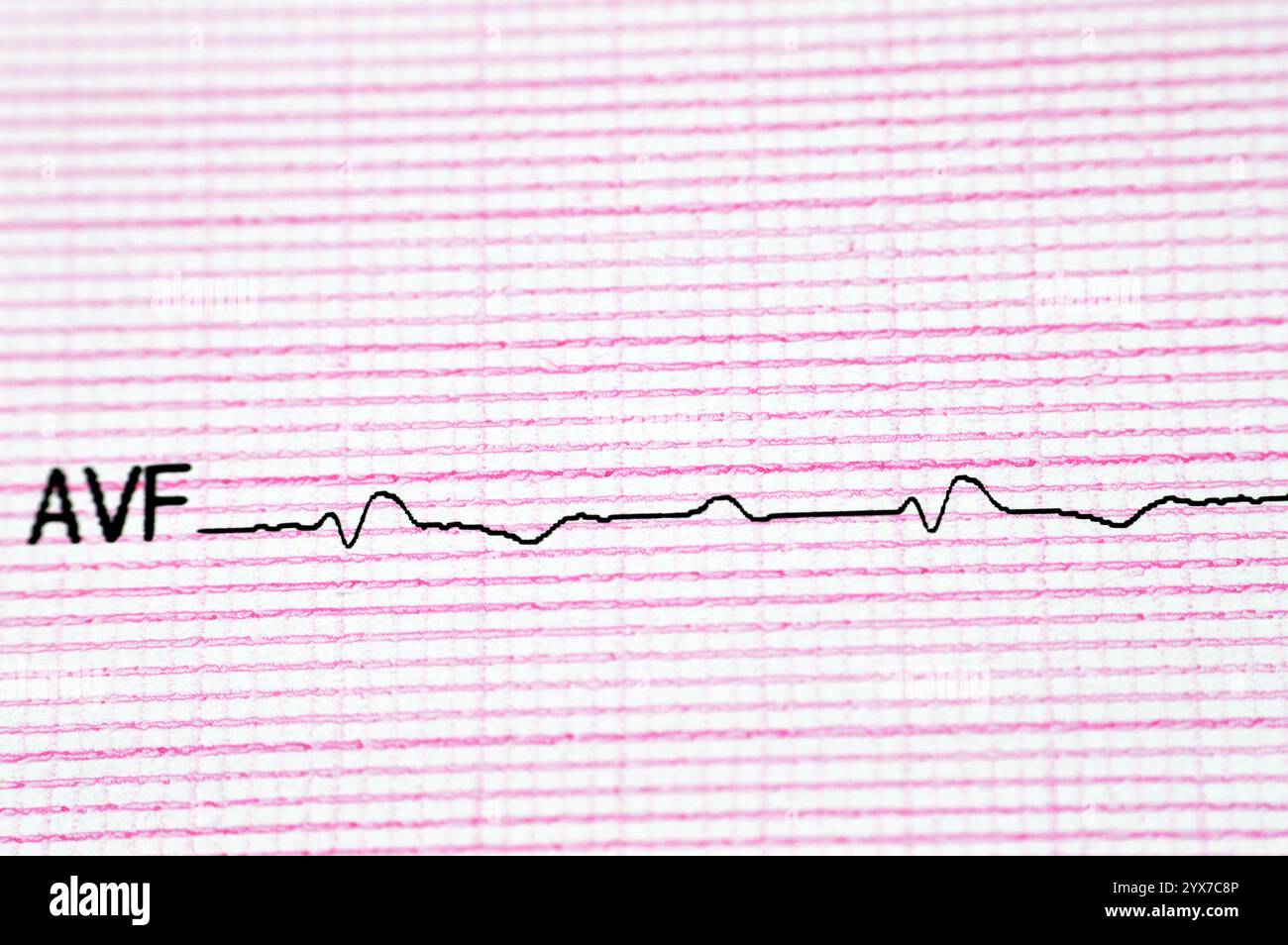 ElectroCardioGraph ECG, a chart that draws the electricity of the heart ...