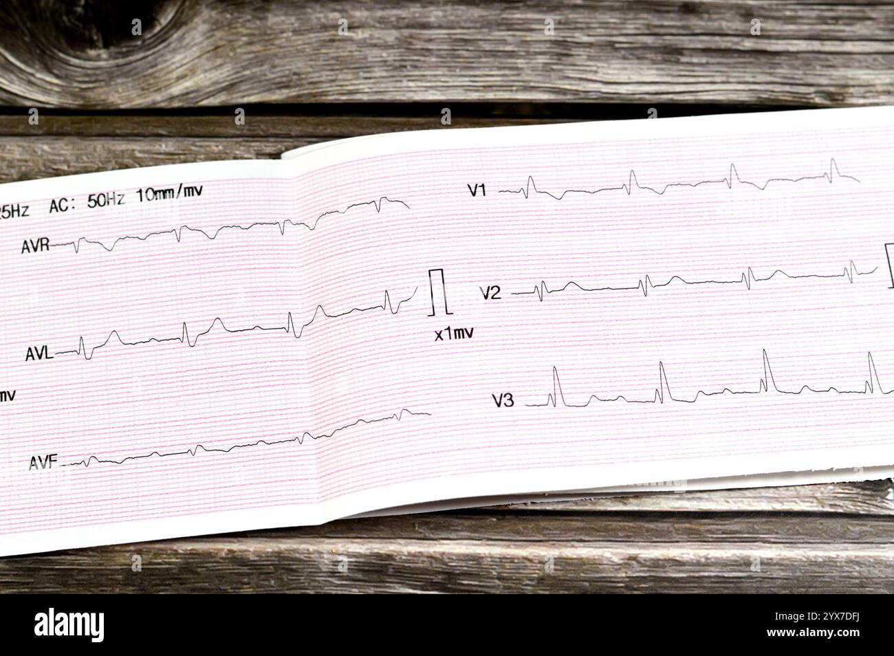 Cairo, Egypt, November 15 2024: ElectroCardioGraph ECG, a chart that ...