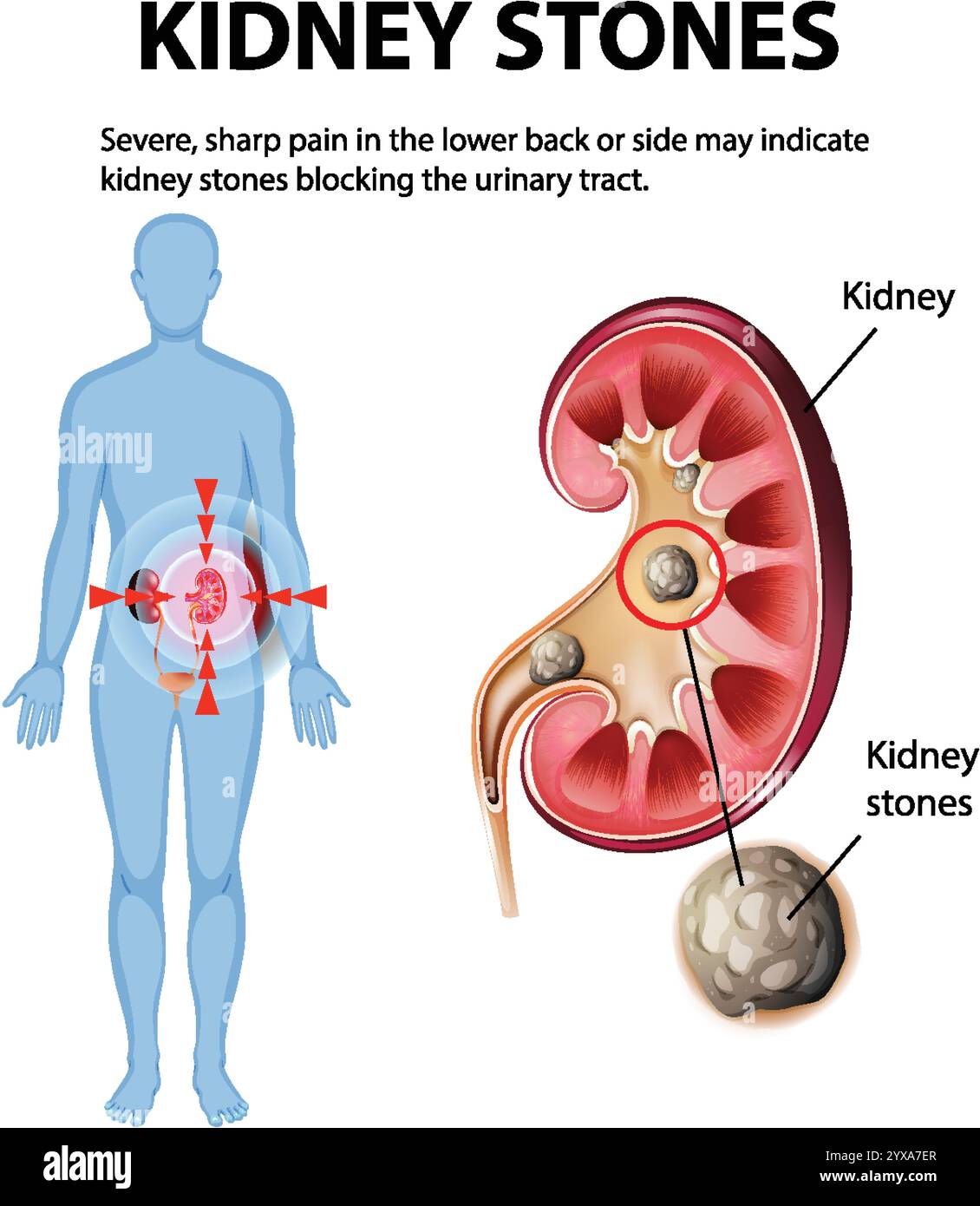 Illustration of kidney stones causing severe pain Stock Vector Image ...