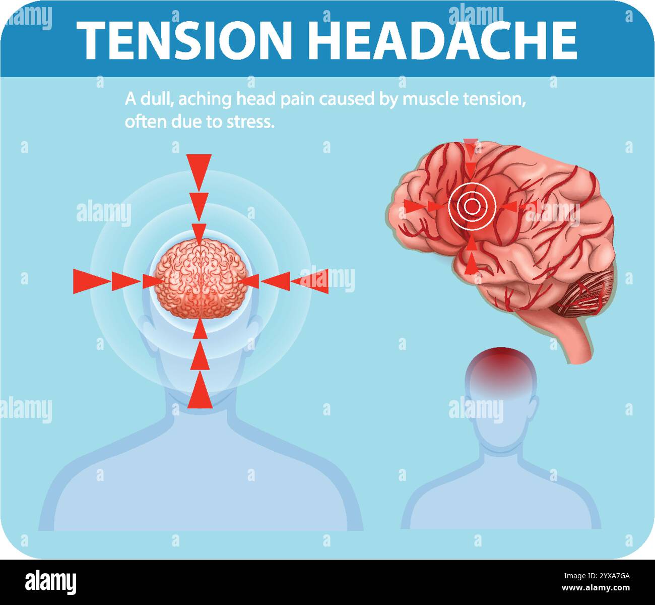 Illustration of tension headache symptoms and brain anatomy Stock ...