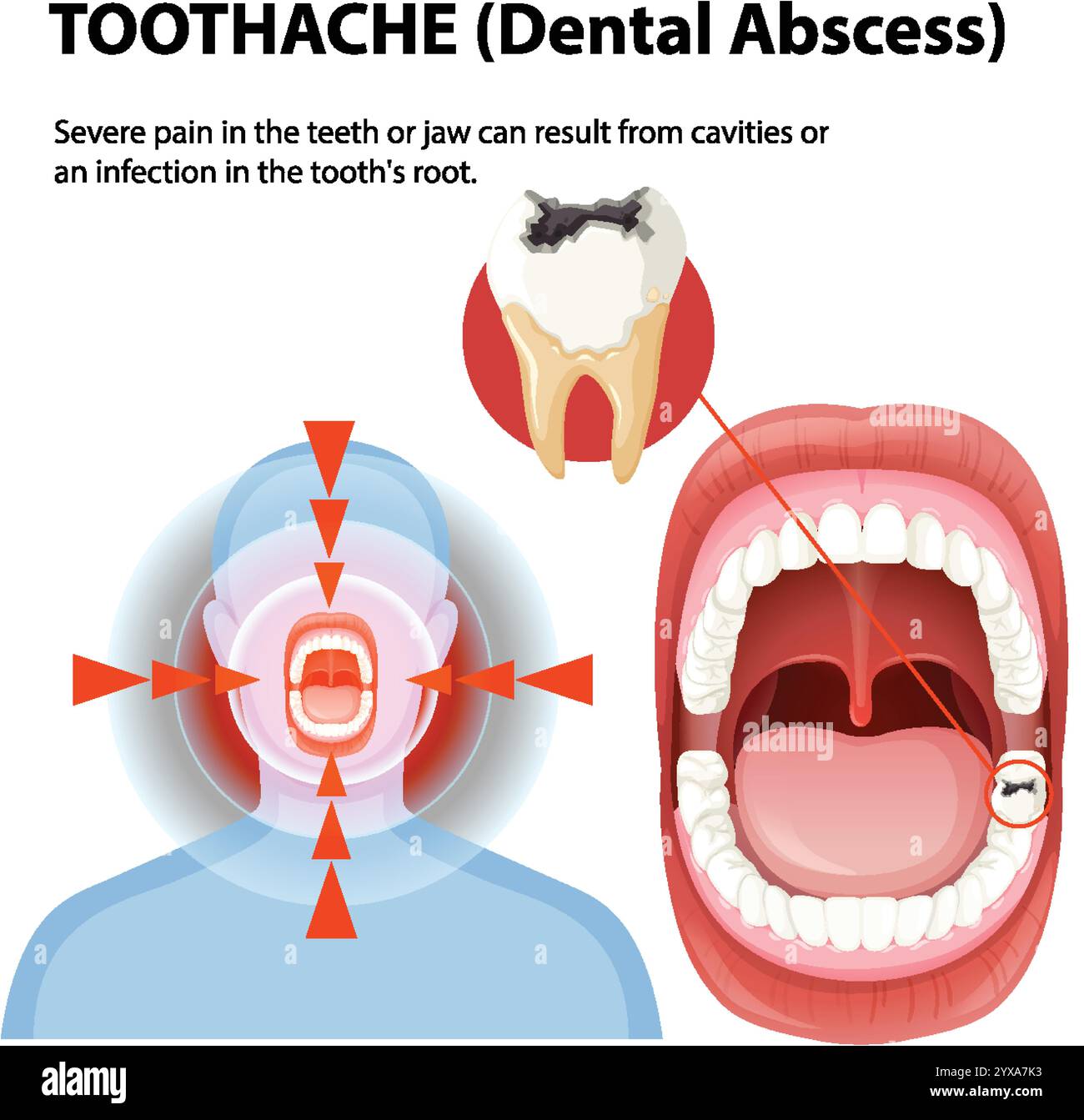 Illustration of toothache causes and symptoms Stock Vector Image & Art ...