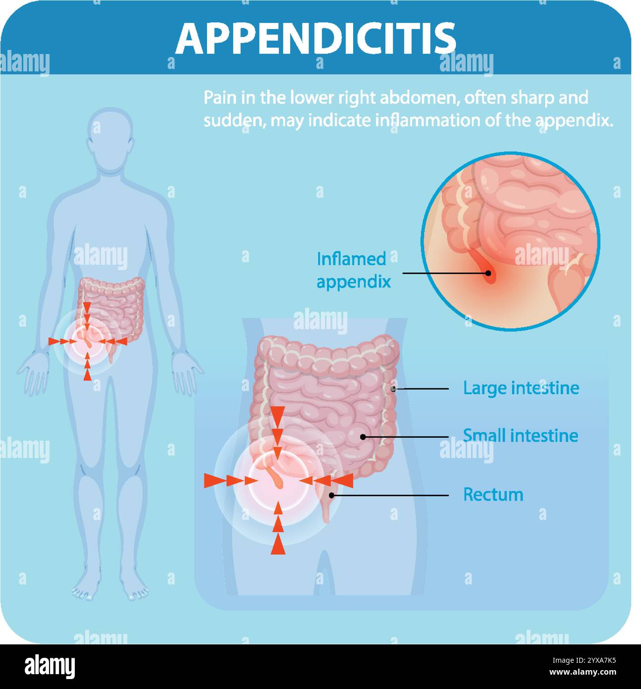 Appendicitis treatment vector vectors hi-res stock photography and ...